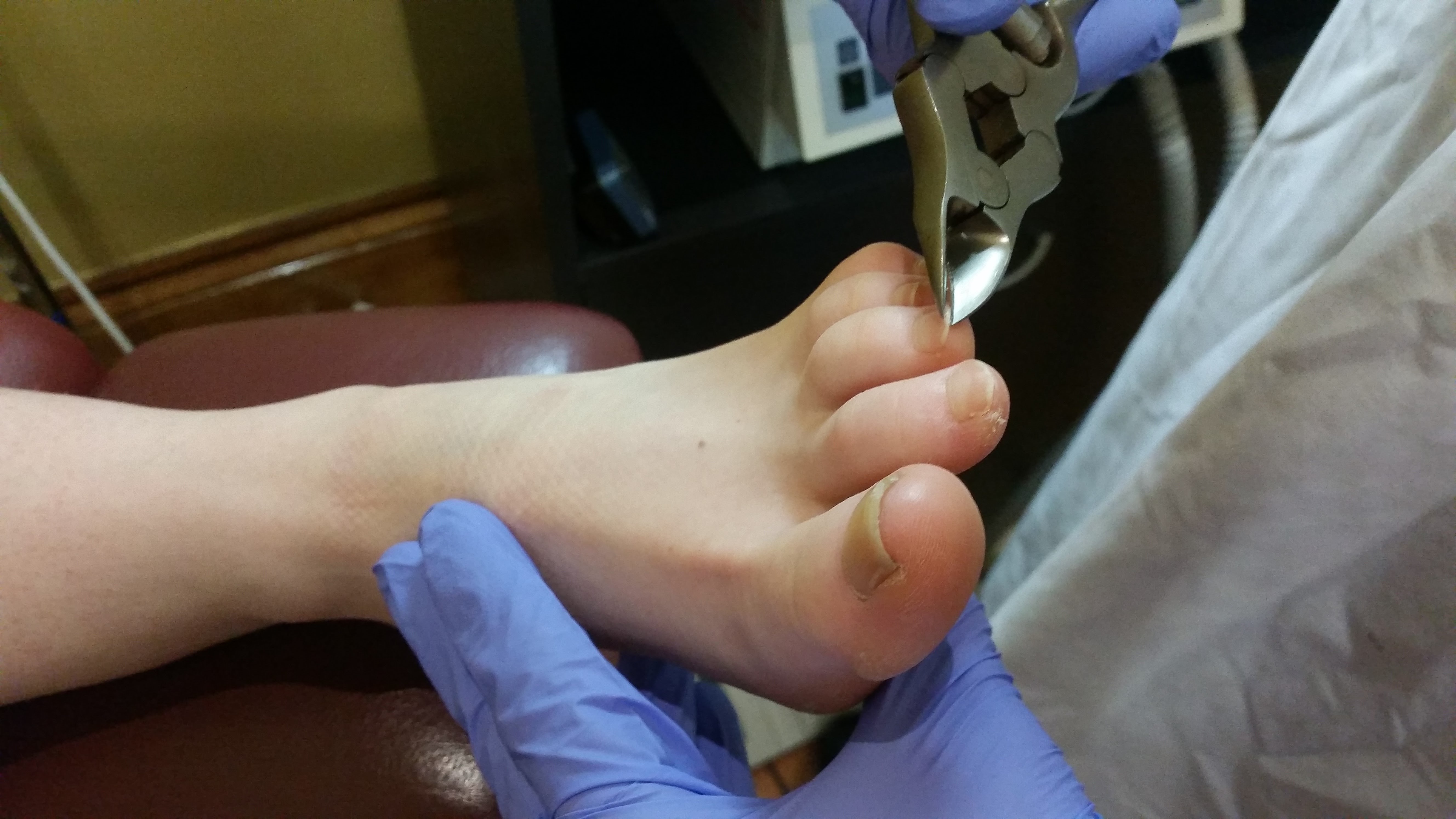 Routine toenail treatment – Podiatry on Williamson