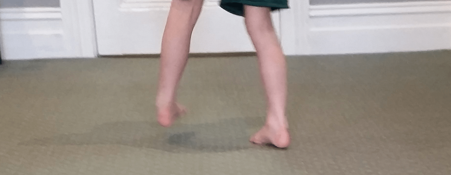 In-toeing – Podiatry on Williamson